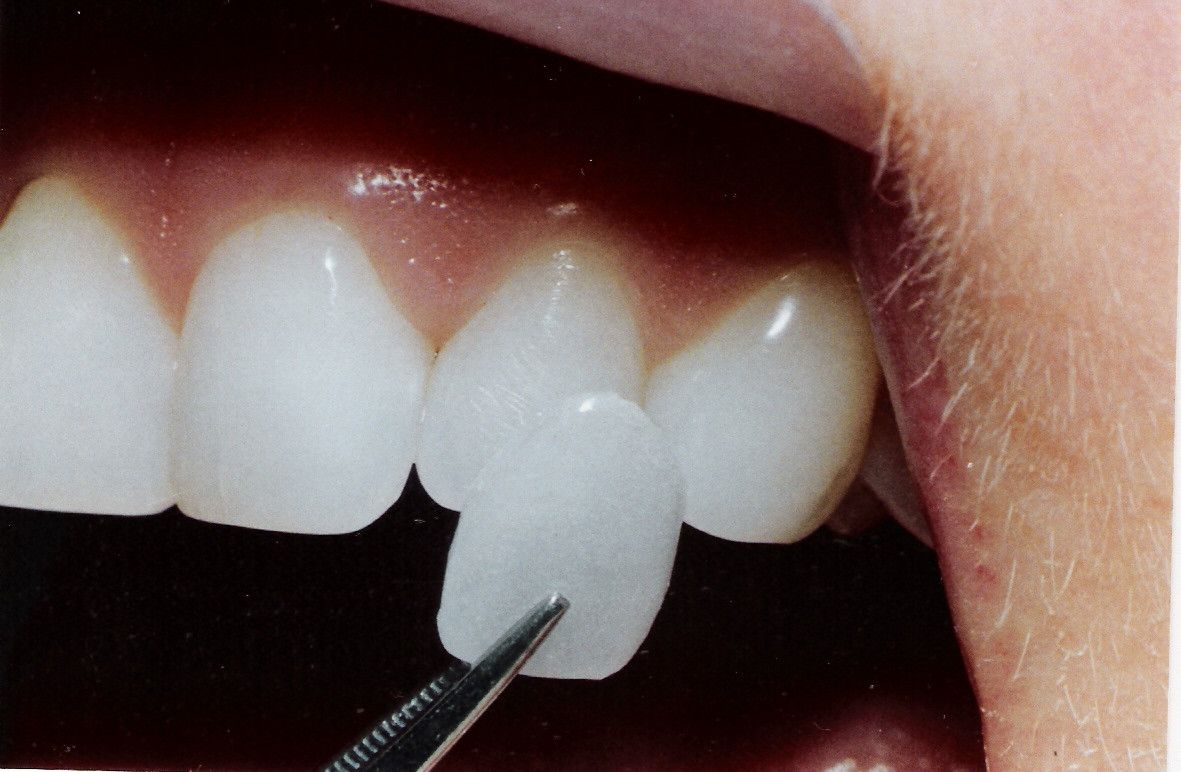 Senyum Menawan dengan Veneers - KlikDokter