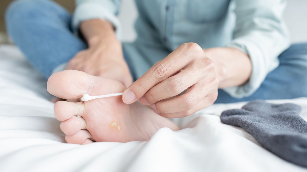 6 Pilihan Obat Medis untuk Mengatasi Kutu Air - KlikDokter