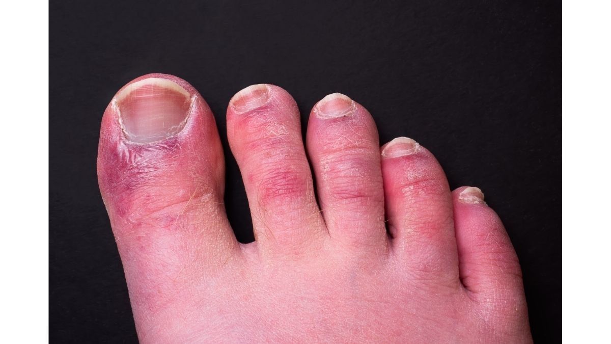 Gejala Infeksi Corona Mirip Cantengan? Waspada COVID Toes - KlikDokter