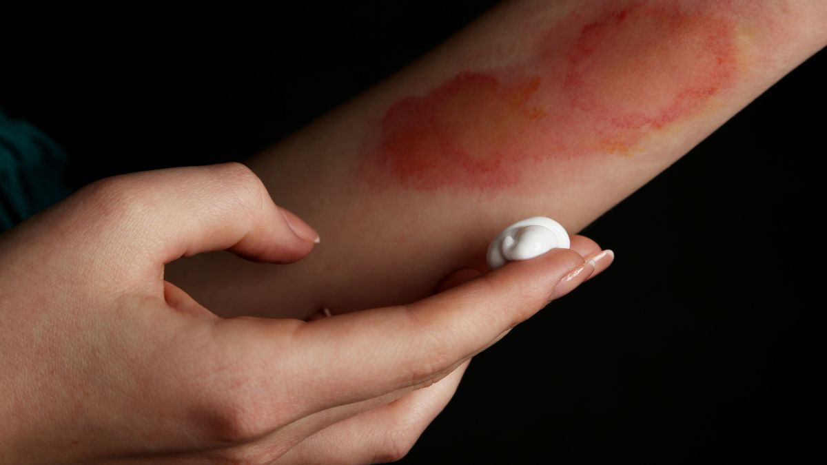 Pilihan Obat Kudis dan Cara Penggunaannya - KlikDokter