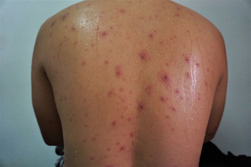 Ini Cara Cepat Obati Cacar Air pada Orang Dewasa - KlikDokter